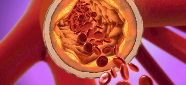 Arteriosclerosis: Eat More (Good) Fat & Fiber to Prevent It! - Dr. Axe