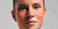 Rosacea Treatment: 6 Natural Remedies to Use - Dr. Axe