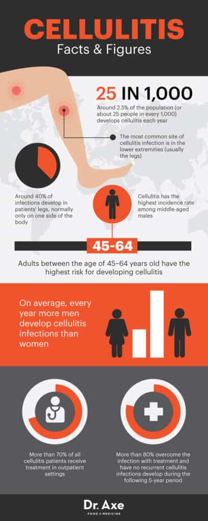 Cellulitis Symptoms, Causes & Risk Factors - Dr. Axe