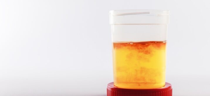 Hematuria (Blood in Urine) Causes, Symptoms and Treatments - Dr. Axe