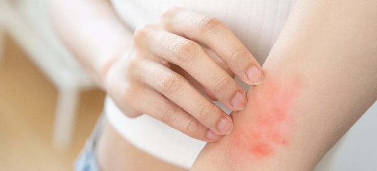 Contact Dermatitis Causes, Symptoms, Natural Treatments - Dr. Axe