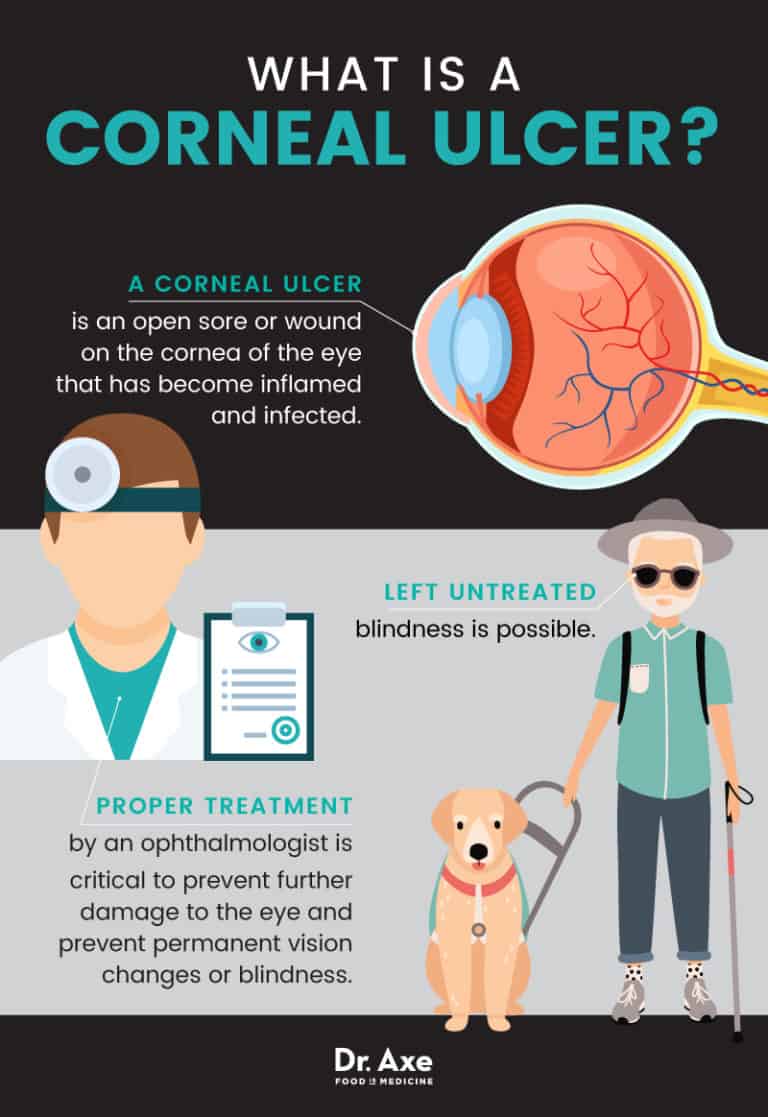 Corneal Ulcer Symptoms + Relieve Symptoms 11 Natural Ways - Dr. Axe