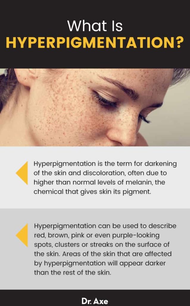 Hyperpigmentation Therapies Plus 5 Natural Skin Care Tips