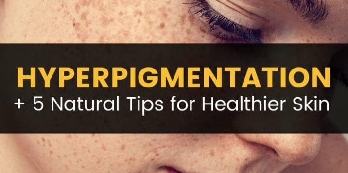 Hyperpigmentation Therapies Plus 5 Natural Skin Care Tips - Dr. Axe