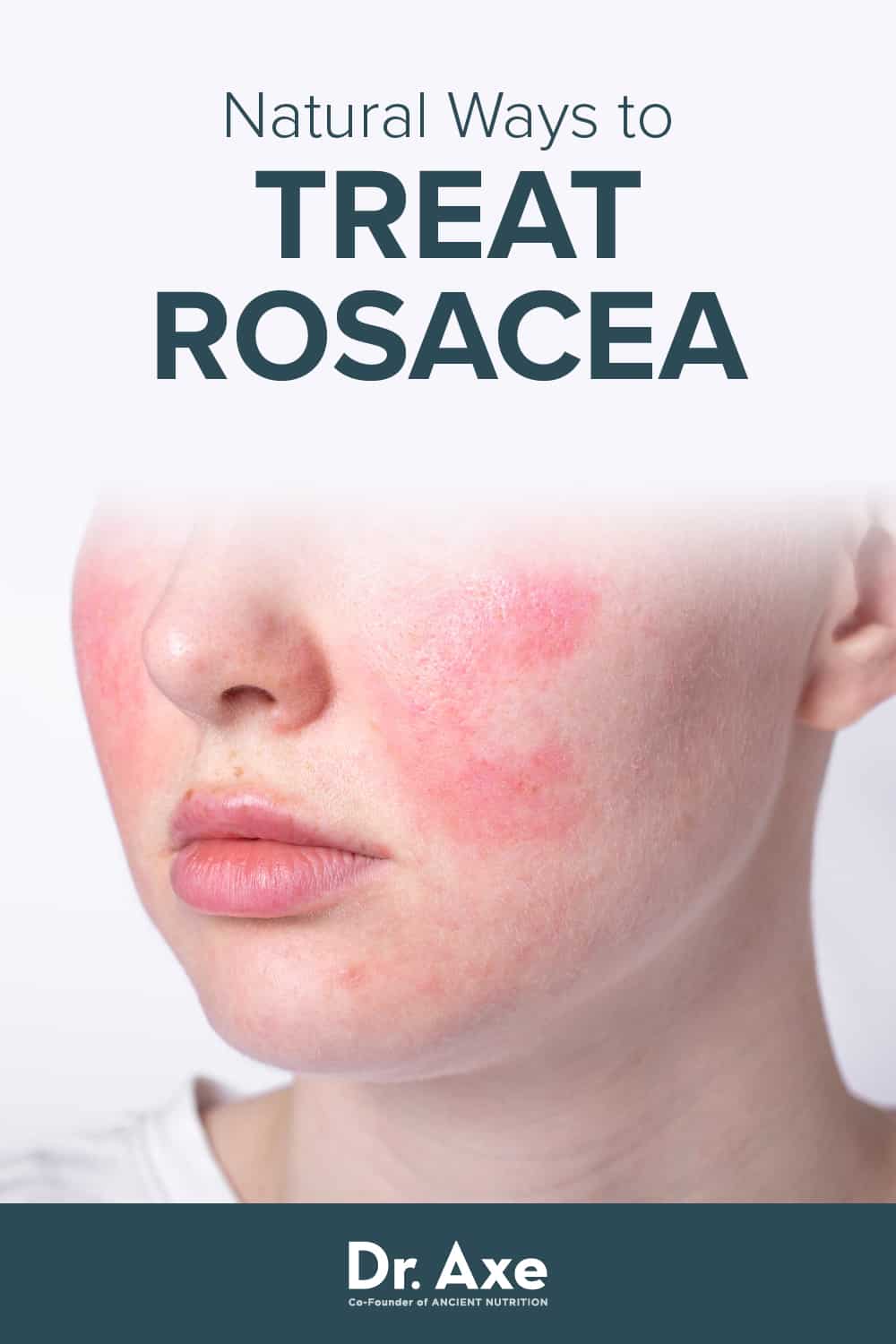 Rosacea Treatment: 6 Natural Remedies to Use - Dr. Axe