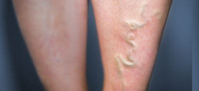 Phlebitis (5 Natural Ways to Improve Symptoms) - Dr. Axe