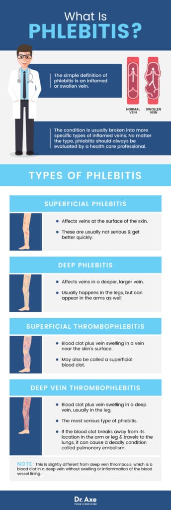 Phlebitis (5 Natural Ways to Improve Symptoms) - Dr. Axe