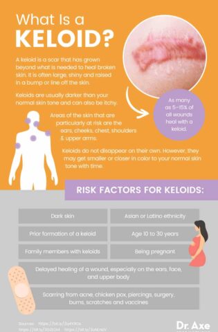 Keloid Causes, Symptoms and Common Treatments - Dr. Axe