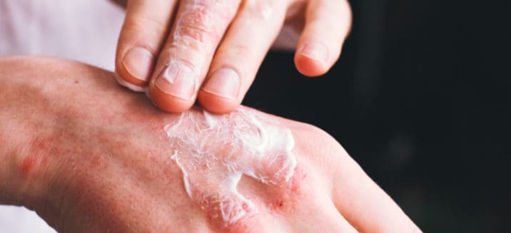 Pellagra (+ 5 Natural Ways to Treat Niacin Deficiency) - Dr. Axe