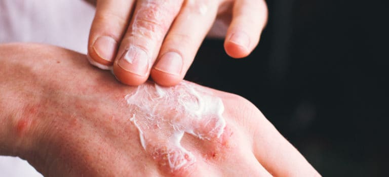 Pellagra (+ 5 Natural Ways to Treat Niacin Deficiency) - Dr. Axe