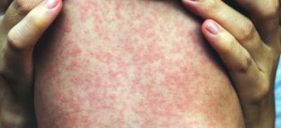 Rocky Mountain Spotted Fever (Prevention + Treatment) - Dr. Axe