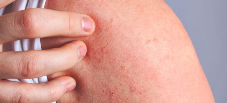 Pityriasis Rosea: 6 Natural Ways to Help Treat 'Christmas Tree' Rash