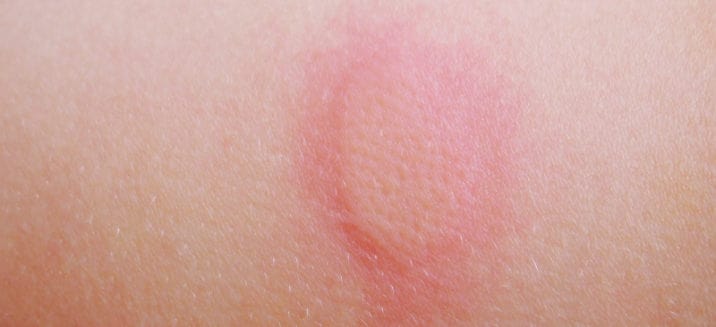 Erythema (+ 5 Natural Ways to Soothe Erythema Symptoms)