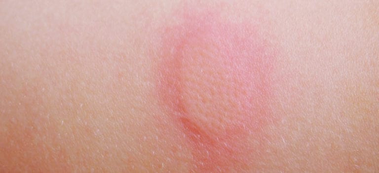 Erythema (+ 5 Natural Ways to Soothe Erythema Symptoms)
