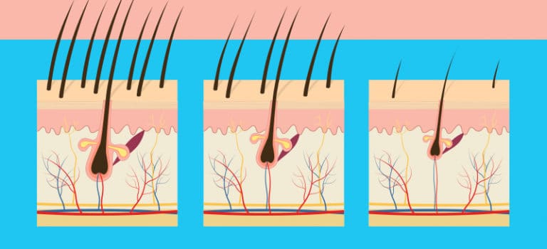 Dht Dihydrotestosterone Its Role In Hair Loss And How To Reduce It