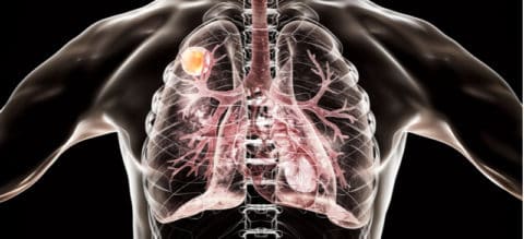 What Exactly Does It Mean to Be Immunocompromised? - Dr. Axe