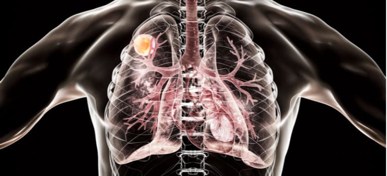 What Exactly Does It Mean to Be Immunocompromised? - Dr. Axe