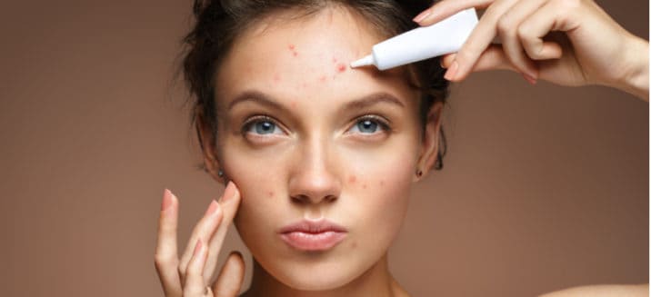 Benzoyl Peroxide for Acne: Benefits, Uses, Side Effects and More - Dr. Axe