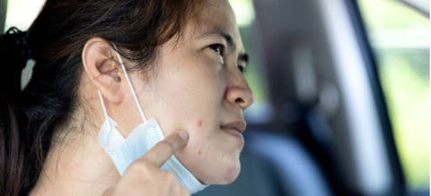 Maskne: How to Prevent and Treat Acne Due to Wearing a Mask