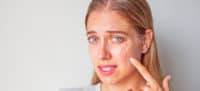 Nodular Acne Symptoms, Causes, Treatments and More - Dr. Axe