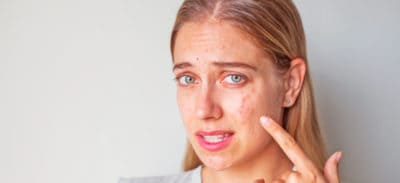 Nodular Acne Symptoms, Causes, Treatments and More - Dr. Axe