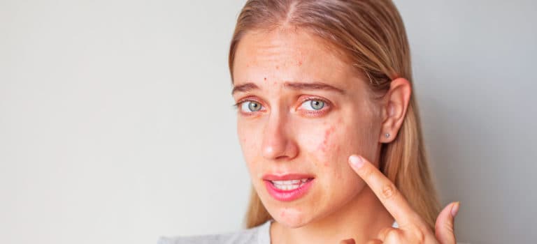 Nodular Acne Symptoms, Causes, Treatments and More - Dr. Axe