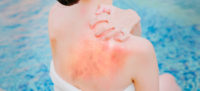 Chlorine Rash Symptoms, Causes, Treatment and Prevention - Dr. Axe