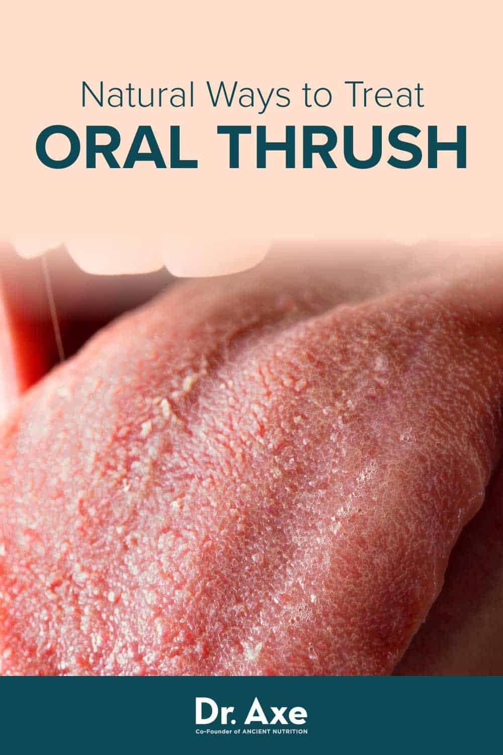 Oral Thrush Symptoms, Causes, Treatment, Prevention - Dr. Axe