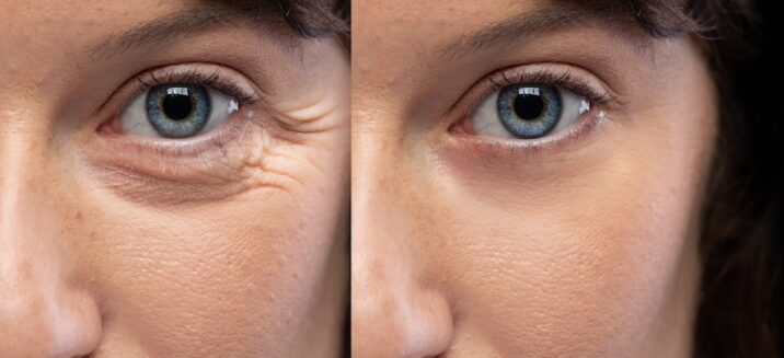 How to Get Rid of Crow's Feet: Causes, Treatment and Prevention - Dr. Axe