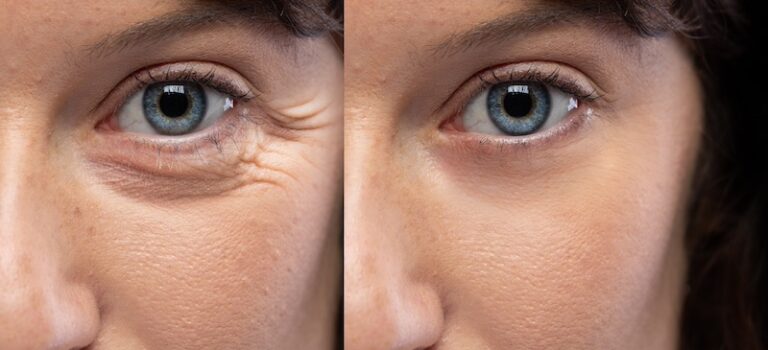 How to Get Rid of Crow's Feet: Causes, Treatment and Prevention - Dr. Axe